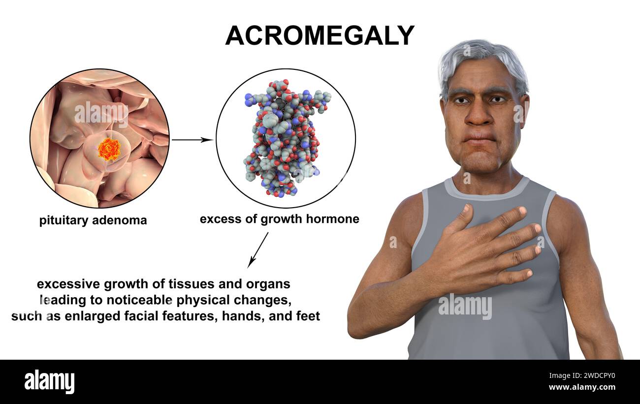 Acromegaly hi-res stock photography and images - Alamy