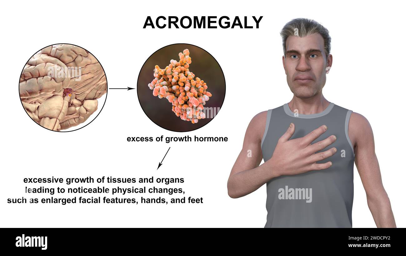 Acromegaly hi-res stock photography and images - Alamy