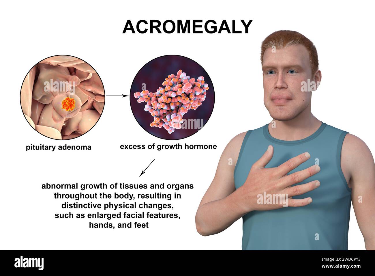 Acromegaly hand hi-res stock photography and images - Alamy