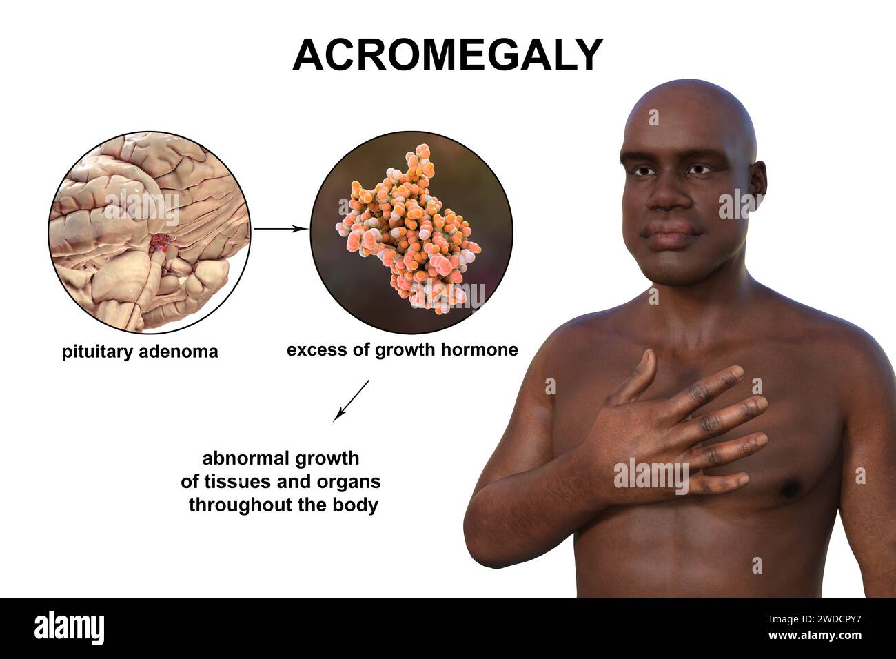 Acromegaly hand hi-res stock photography and images - Alamy