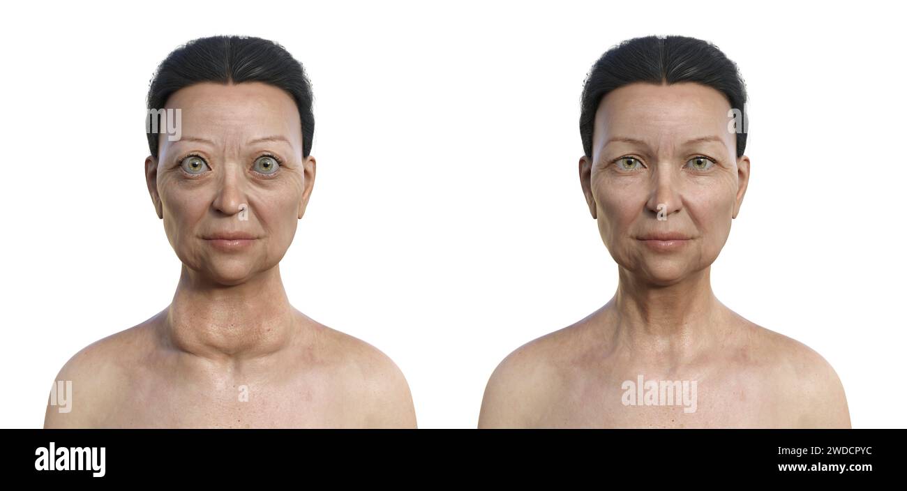 Illustration depicting a woman with Graves' disease showing an enlarged ...