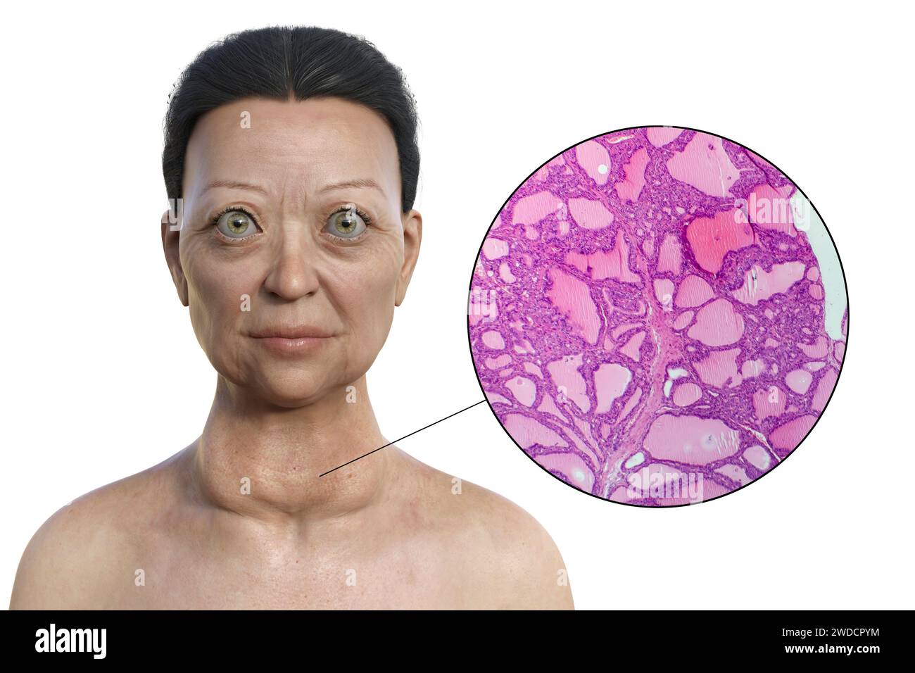 Woman with Graves' disease, illustration Stock Photo - Alamy