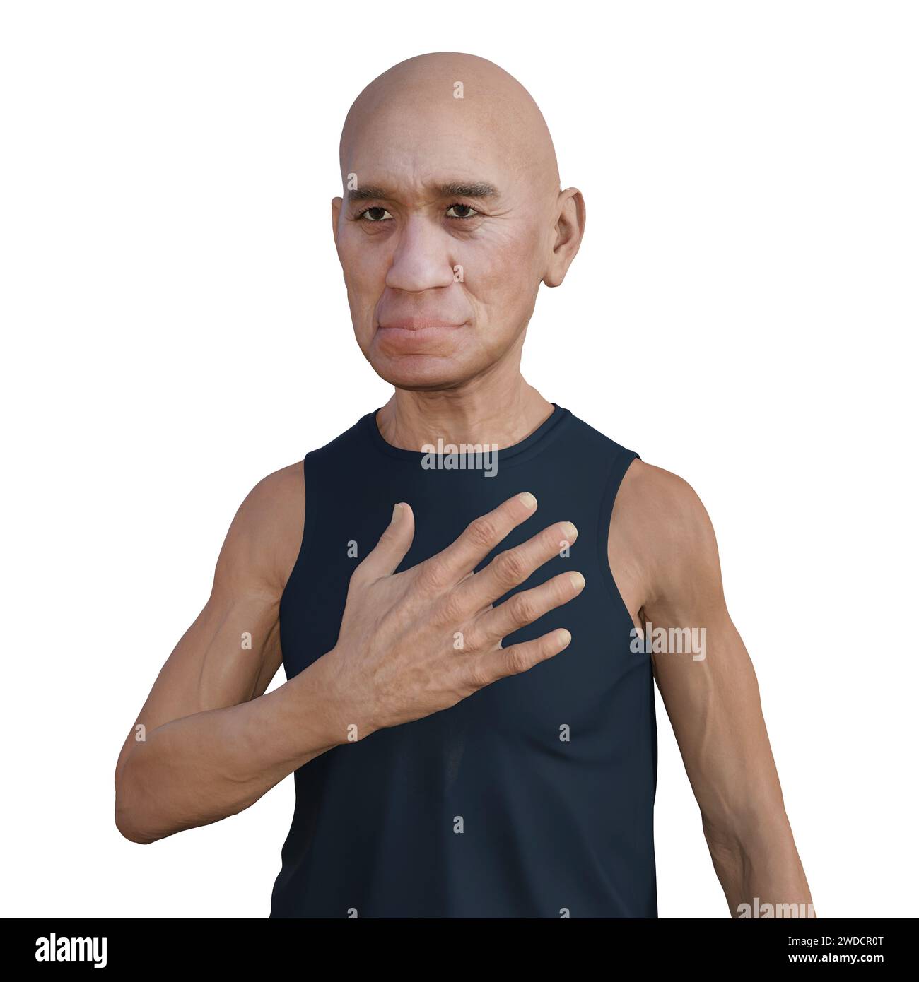 Acromegalia Antes E Depois