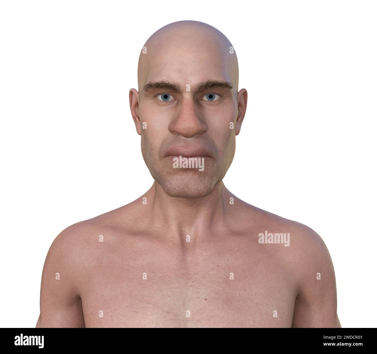 Acromegalia Antes E Depois