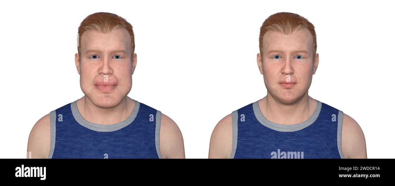 Acromegaly in a man compared to healthy man, illustration Stock Photo ...