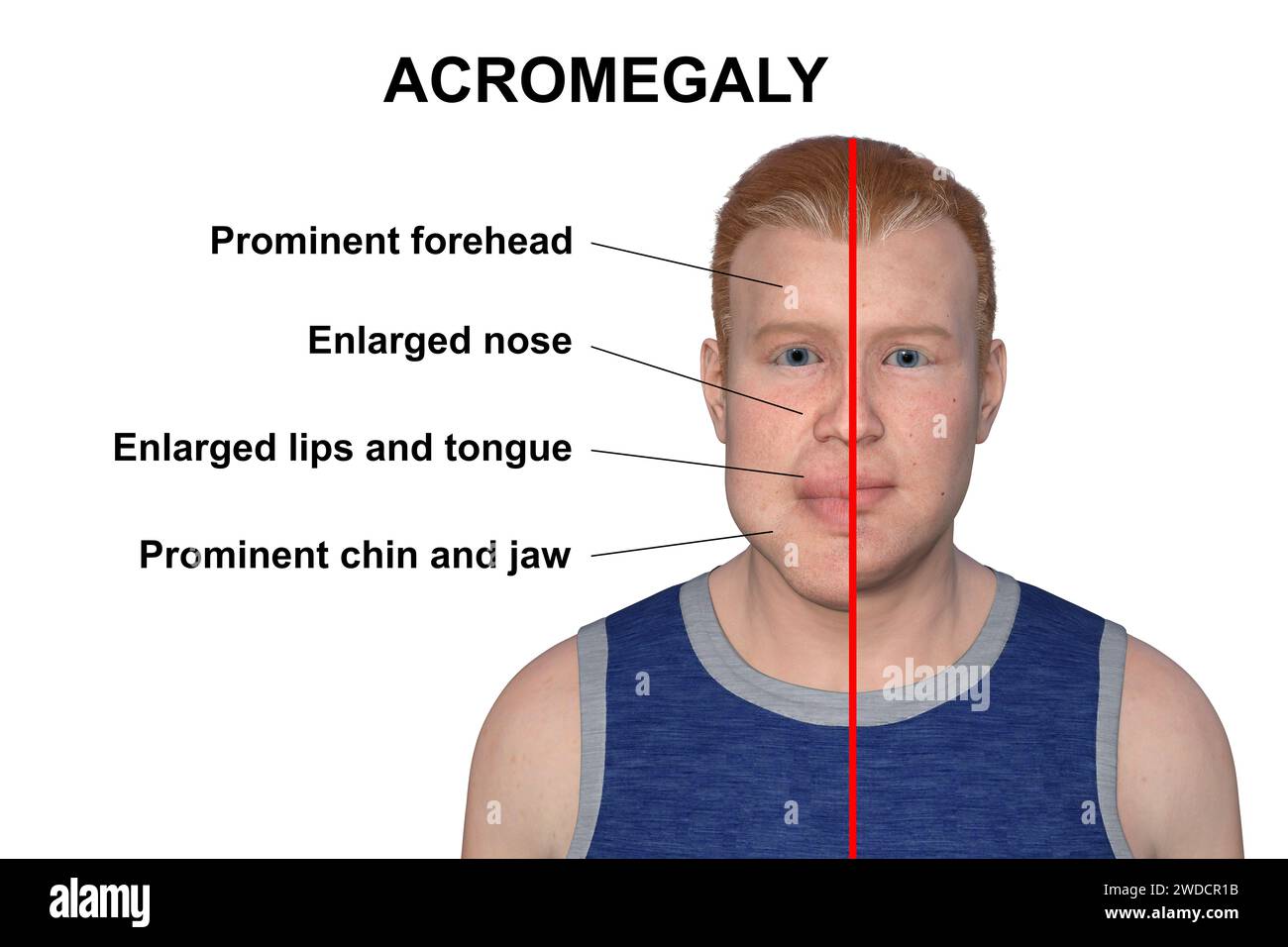 Acromegaly in a man compared to healthy man, illustration Stock Photo ...
