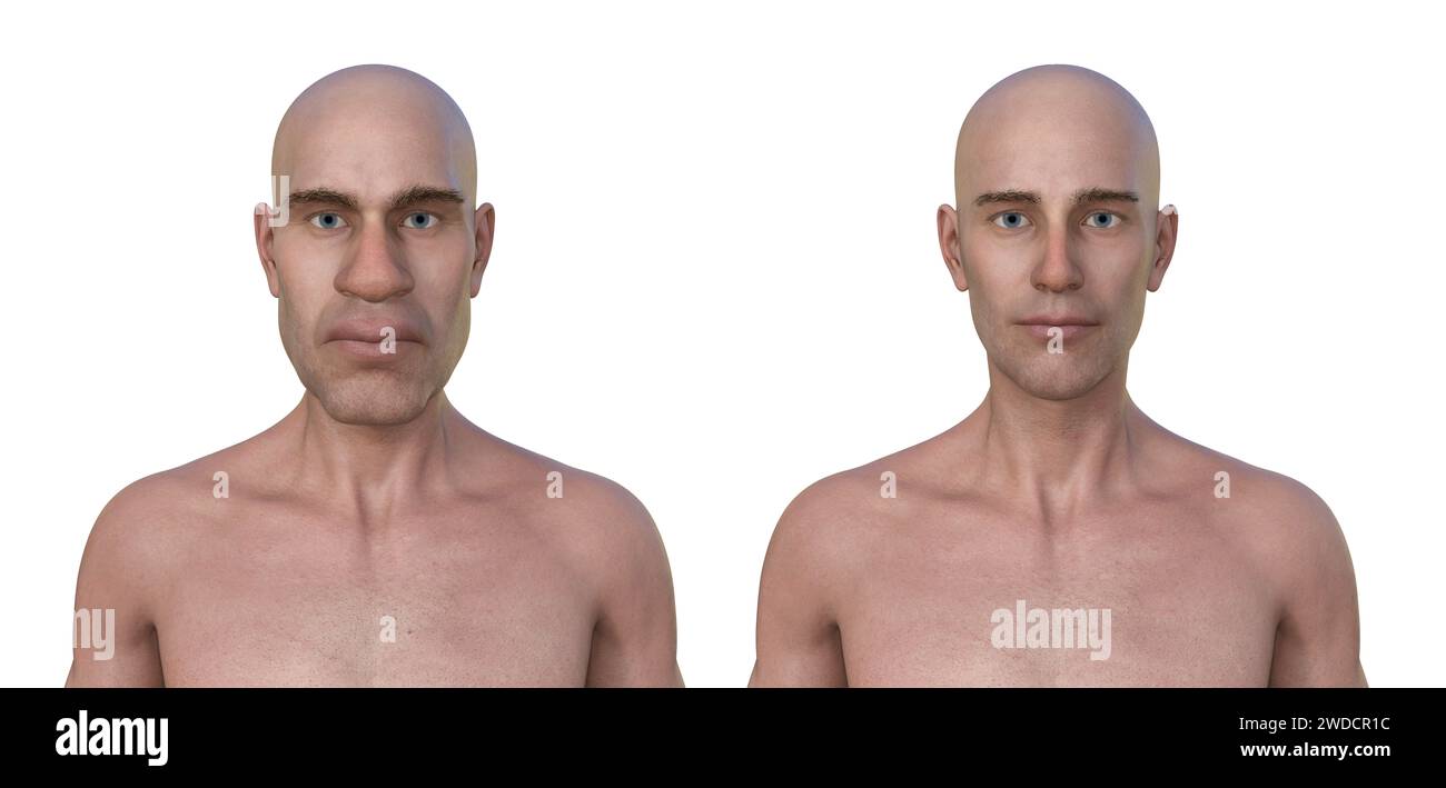 Acromegaly in a man compared to healthy man, illustration Stock Photo ...