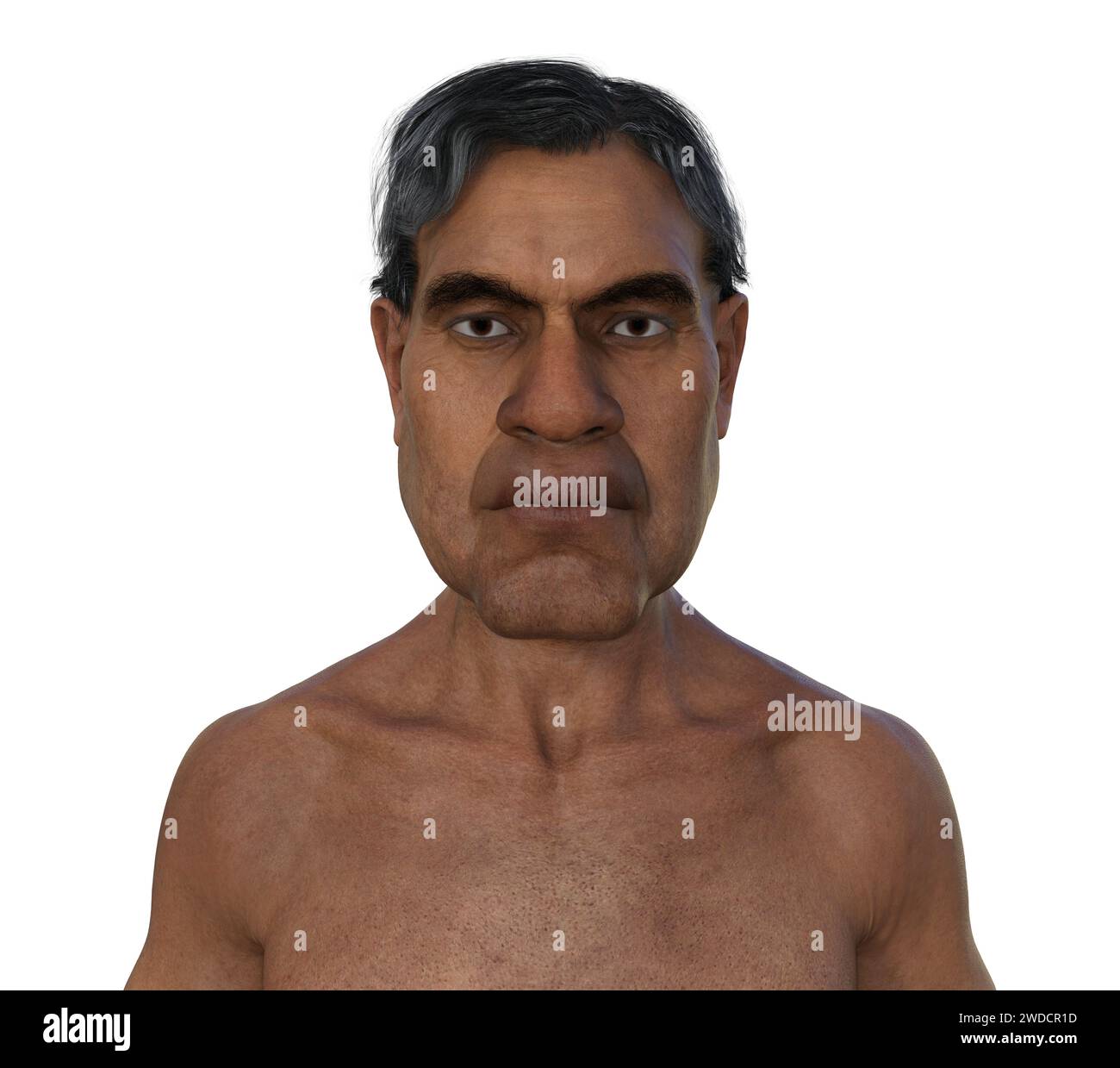 Illustration depicting acromegaly in a man. There is an increase in the ...