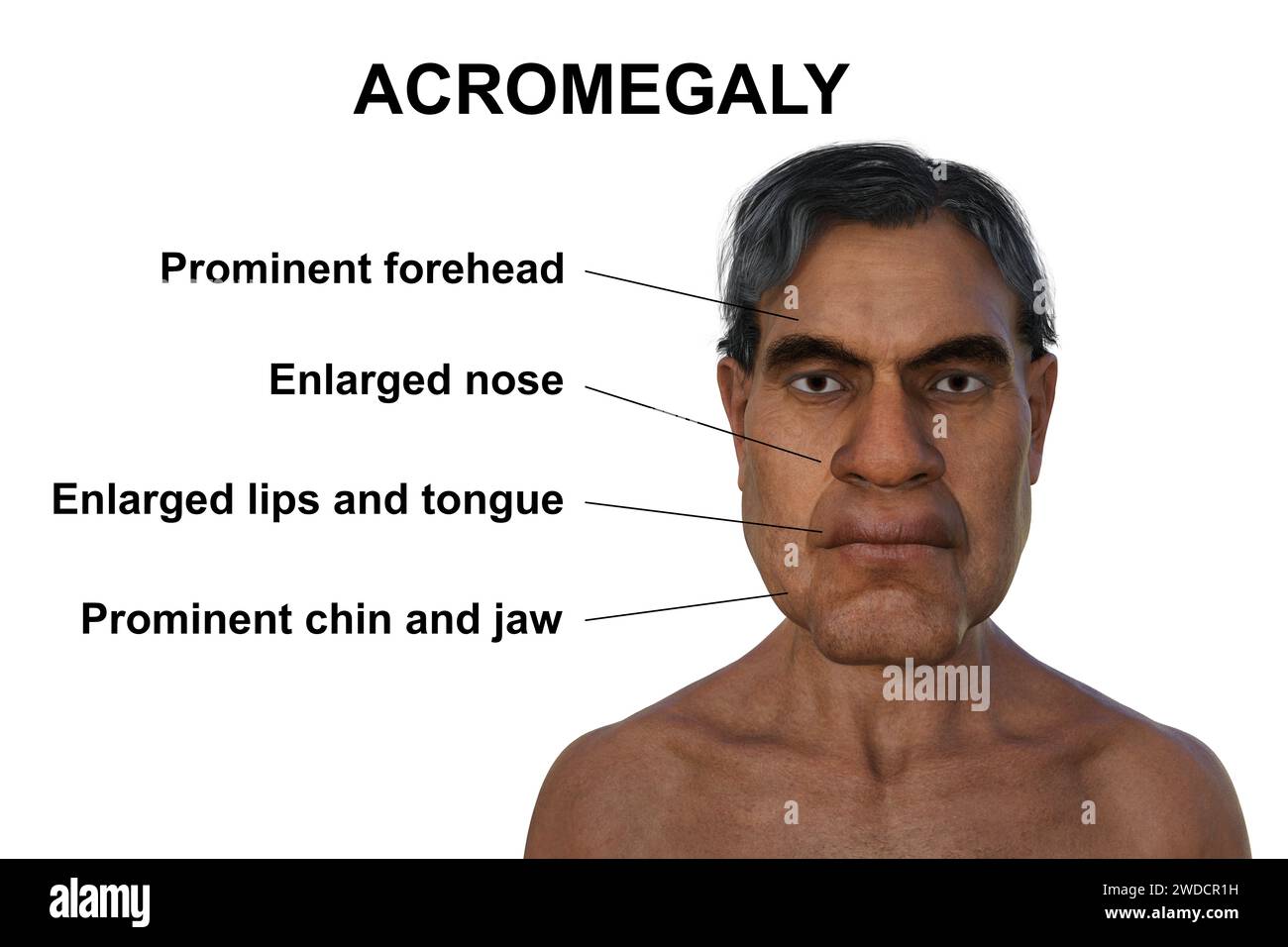 Acromegaly in a man compared to healthy man, illustration Stock Photo ...