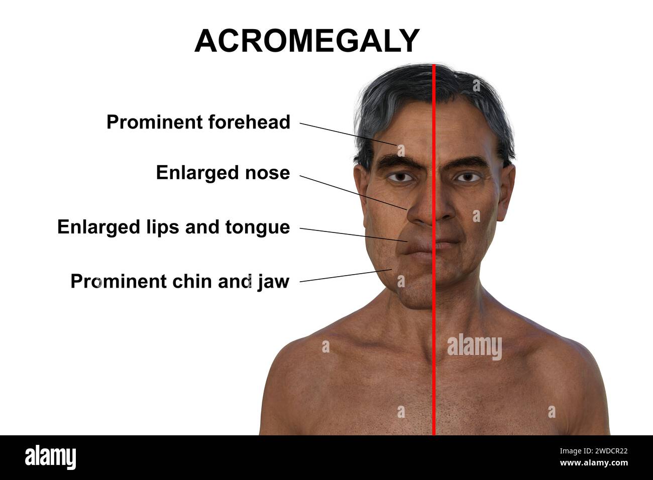 Acromegaly in a man compared to healthy man, illustration Stock Photo ...