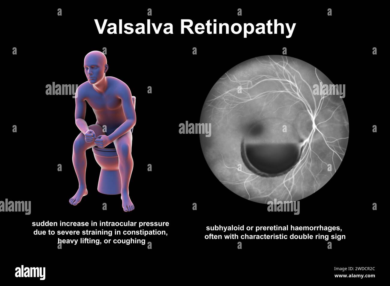 Illustration of Valsalva retinopathy, a pre-retinal haemorrhage caused ...