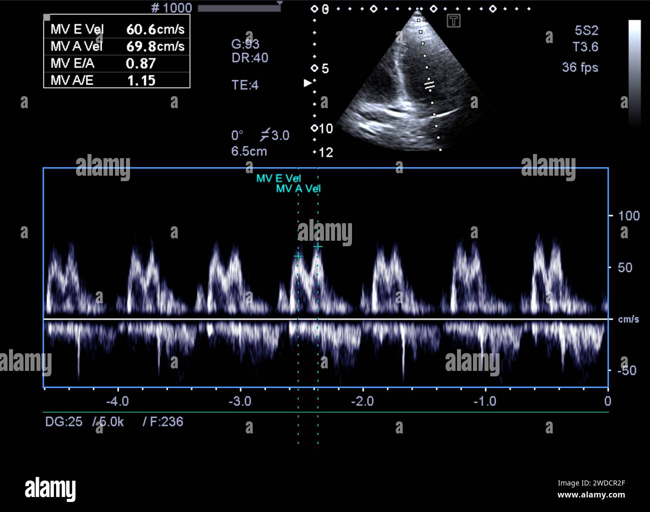 Diastolic dysfunction, echocardiogram Stock Photo - Alamy
