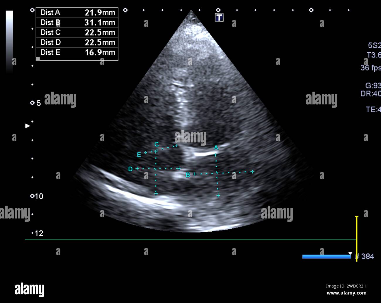 Atrial volume, ultrasound scan Stock Photo - Alamy