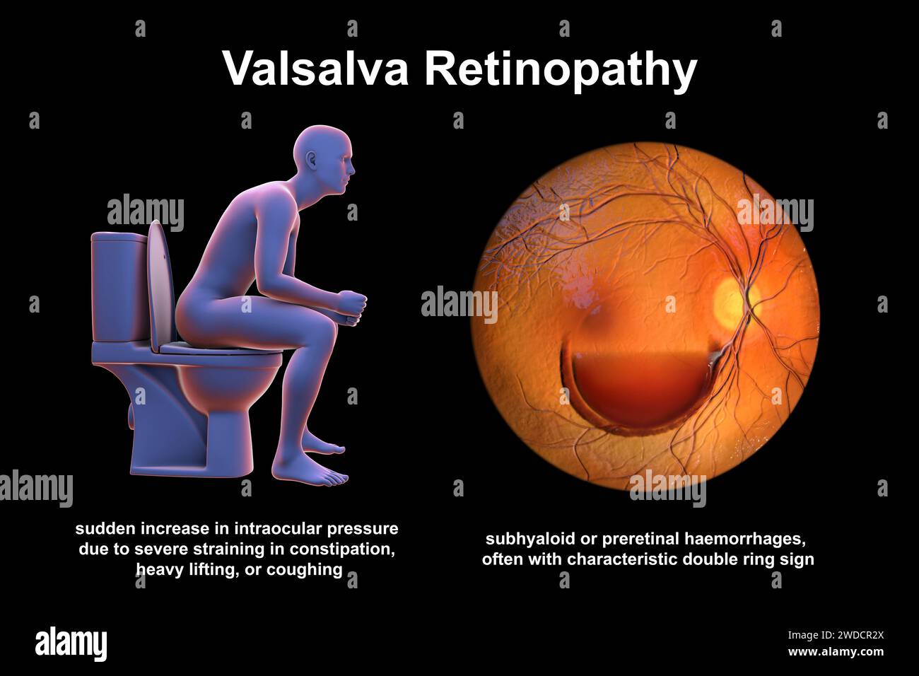 Valsava retinopathy, illustration Stock Photo - Alamy