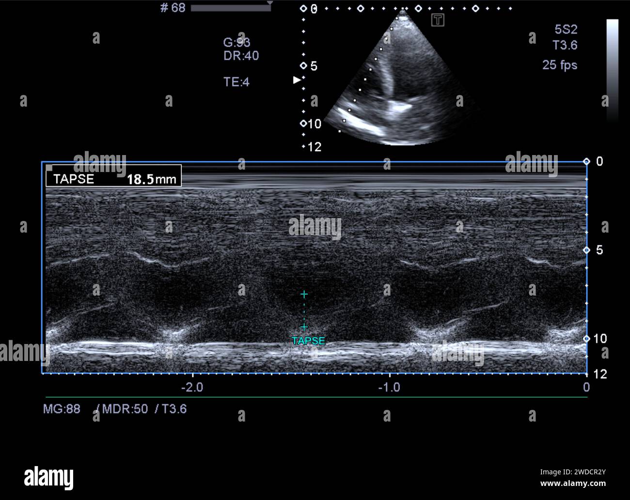 Tricuspid annular plane systolic excursion, ultrasound scan Stock Photo ...