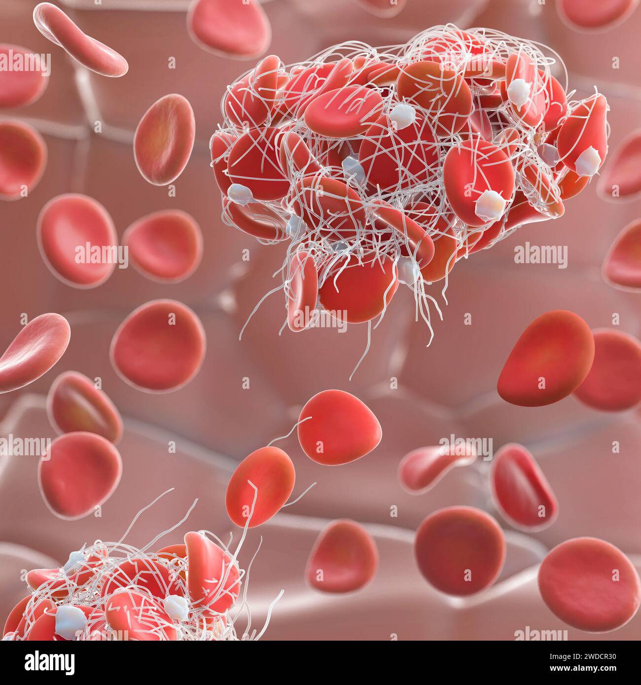 Blood clot, illustration Stock Photo - Alamy