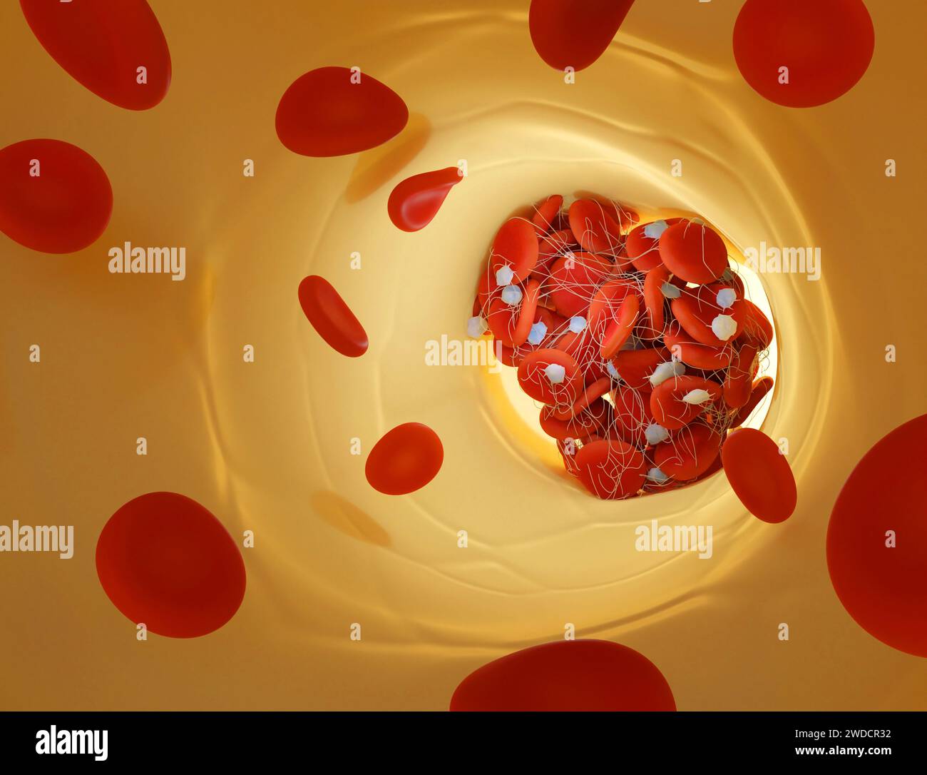 Blood clot clotted hi-res stock photography and images - Alamy