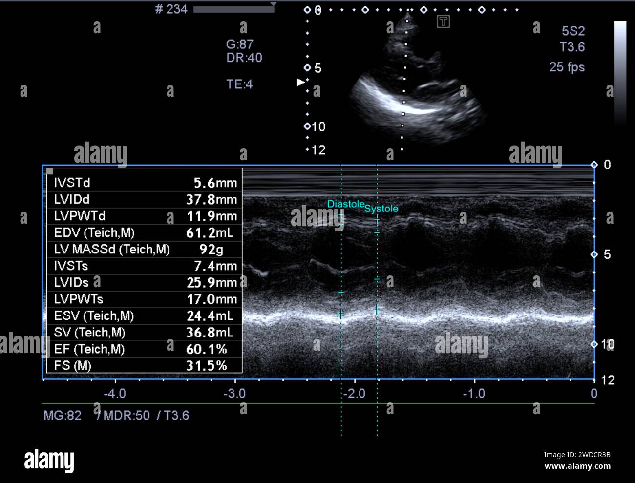 Cardiac output, ulstrasound scan Stock Photo - Alamy