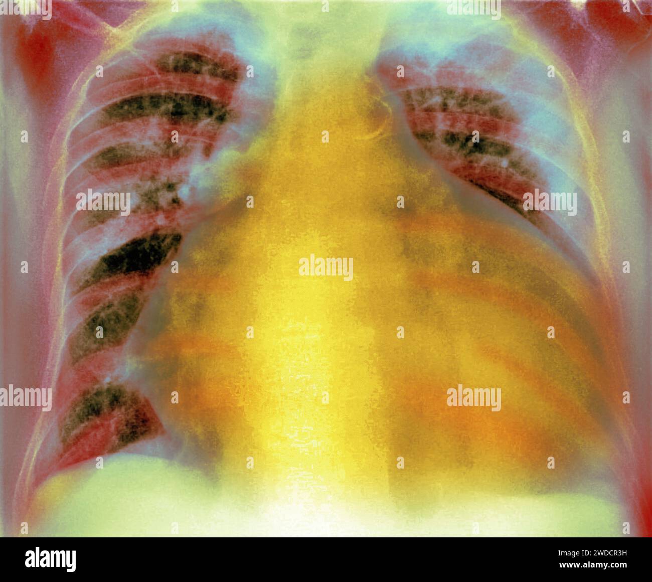 Chest x ray enlarged heart hi-res stock photography and images - Alamy