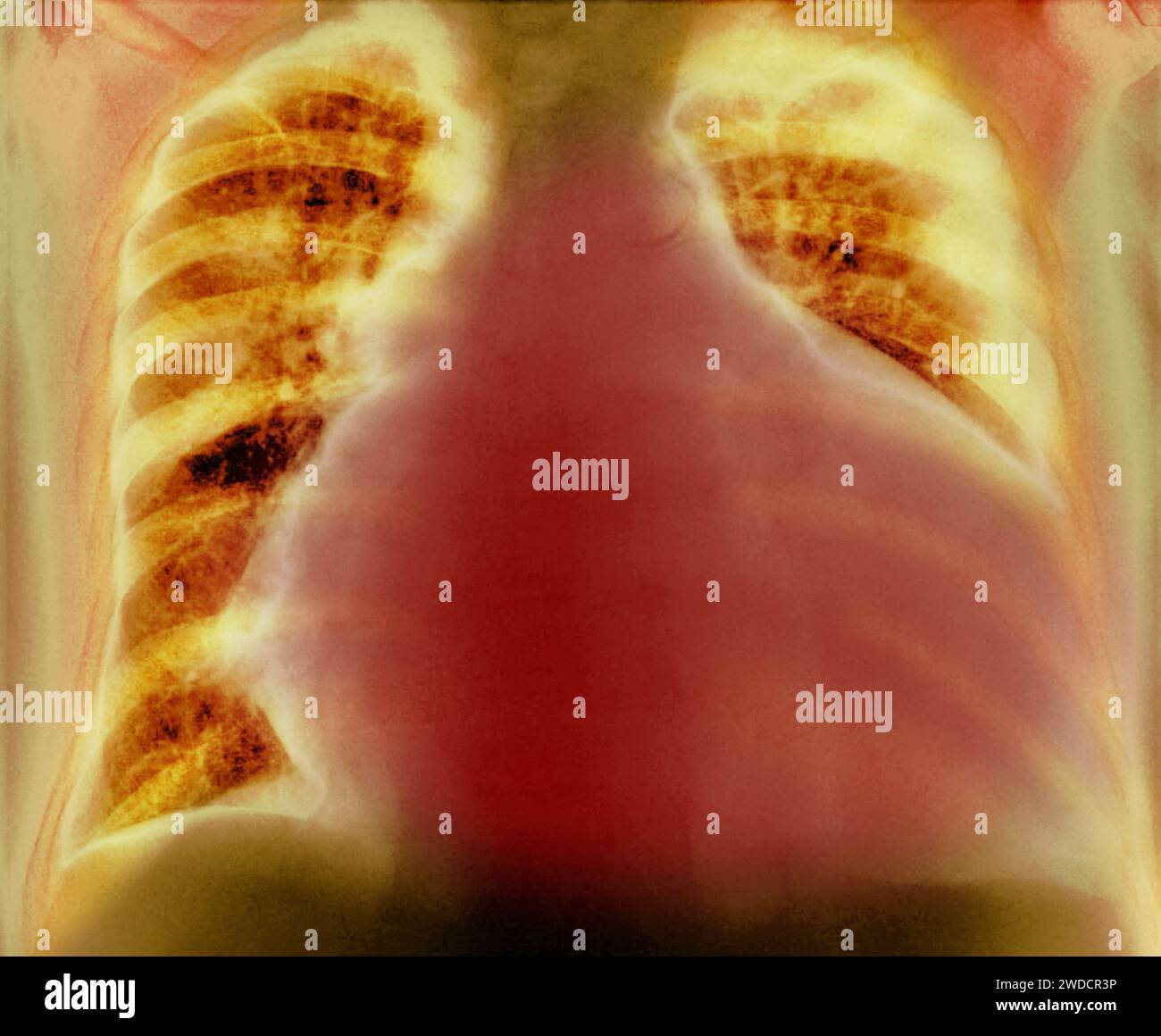 Enlarged heart, X-ray Stock Photo - Alamy