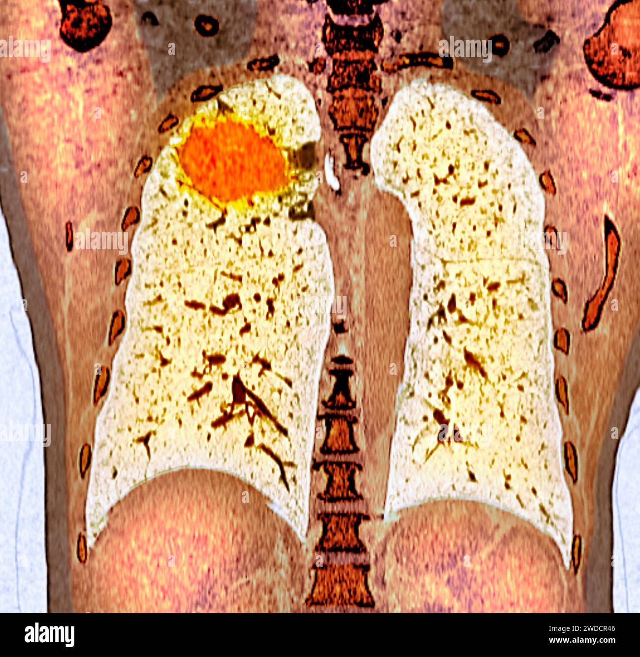 What Does Lung Cancer Look Like In A Ct Scan Ct Scan Machine