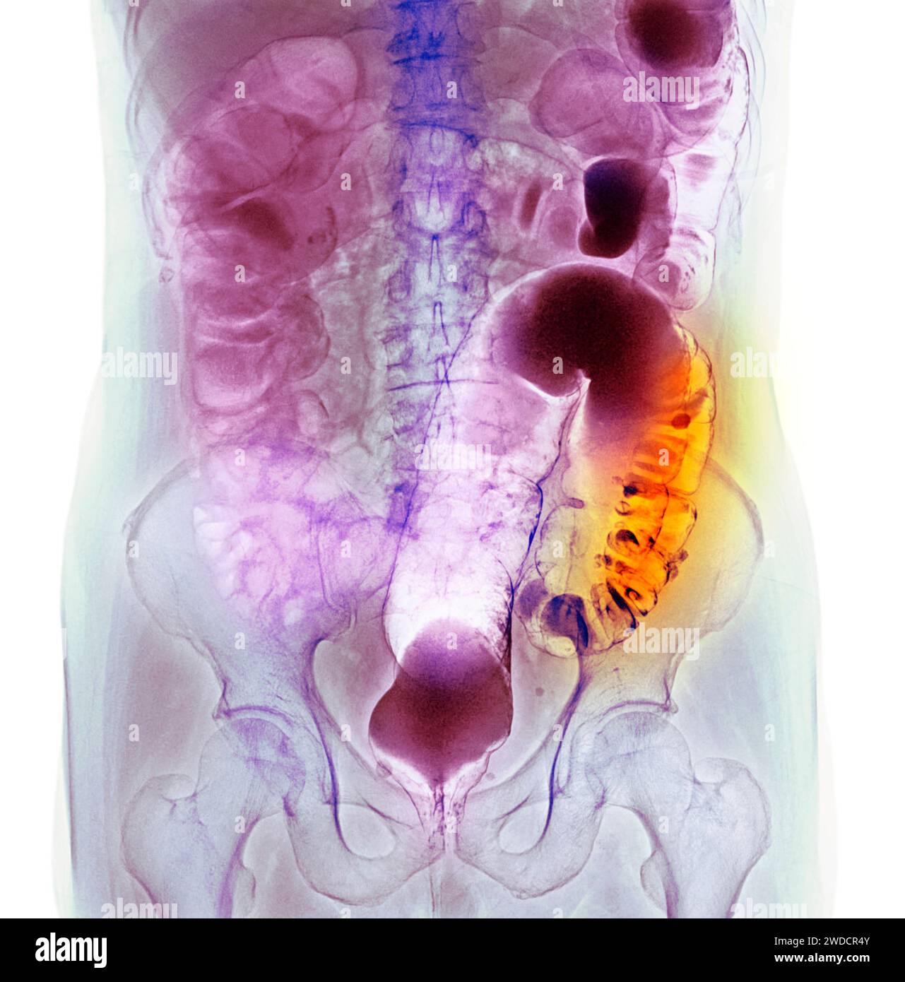 Diverticula hi-res stock photography and images - Alamy