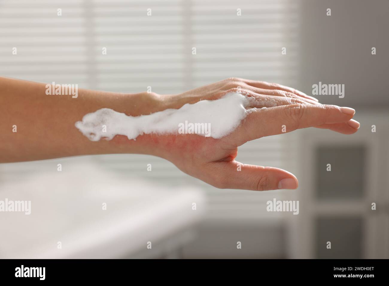 Burn mark on hand hi-res stock photography and images - Alamy