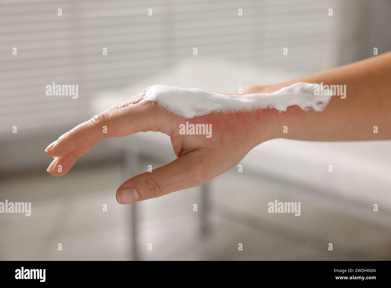 Burn mark on hand hi-res stock photography and images - Alamy