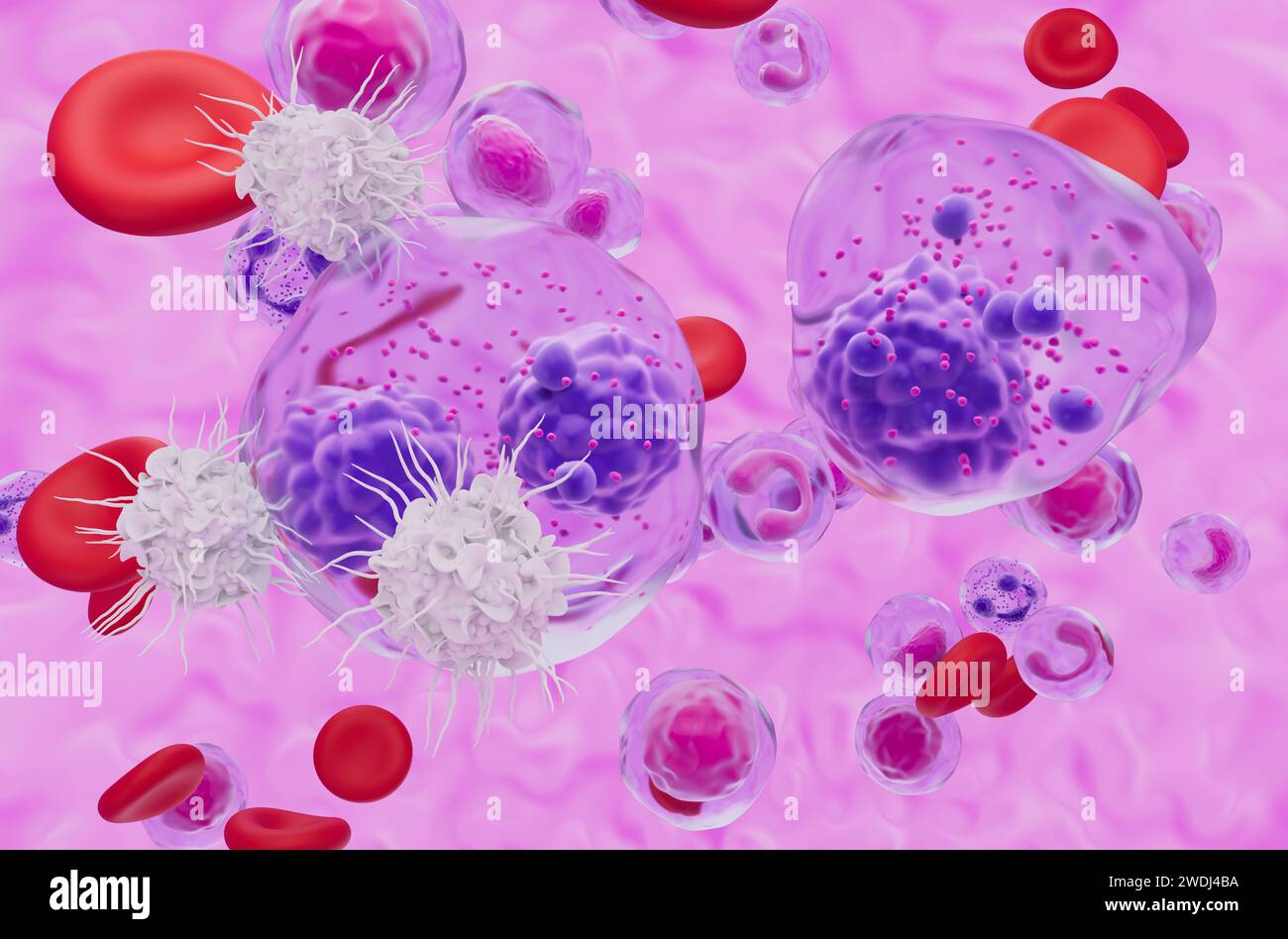 Multiple myeloma bone marrow hi-res stock photography and images - Alamy