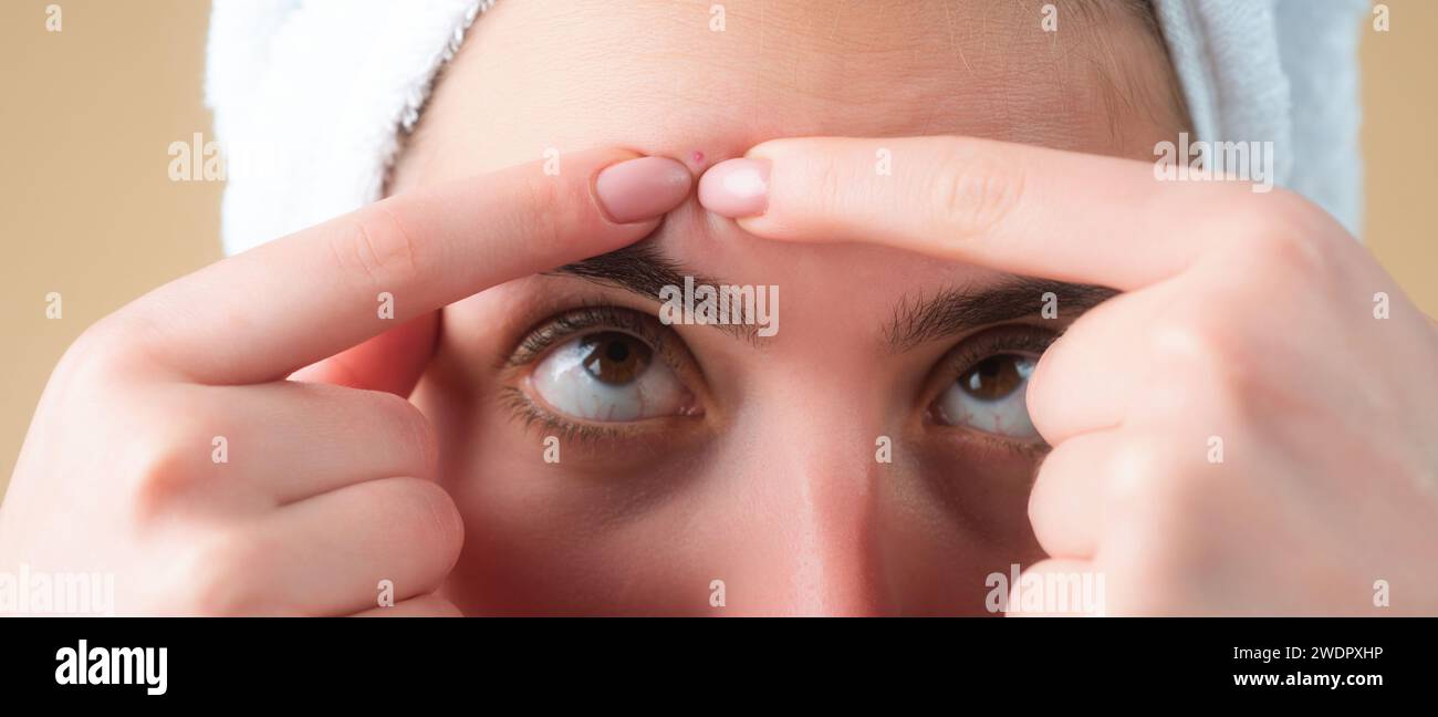 Pustule acne. Close up pimple on female skin. Dermatology, puberty ...