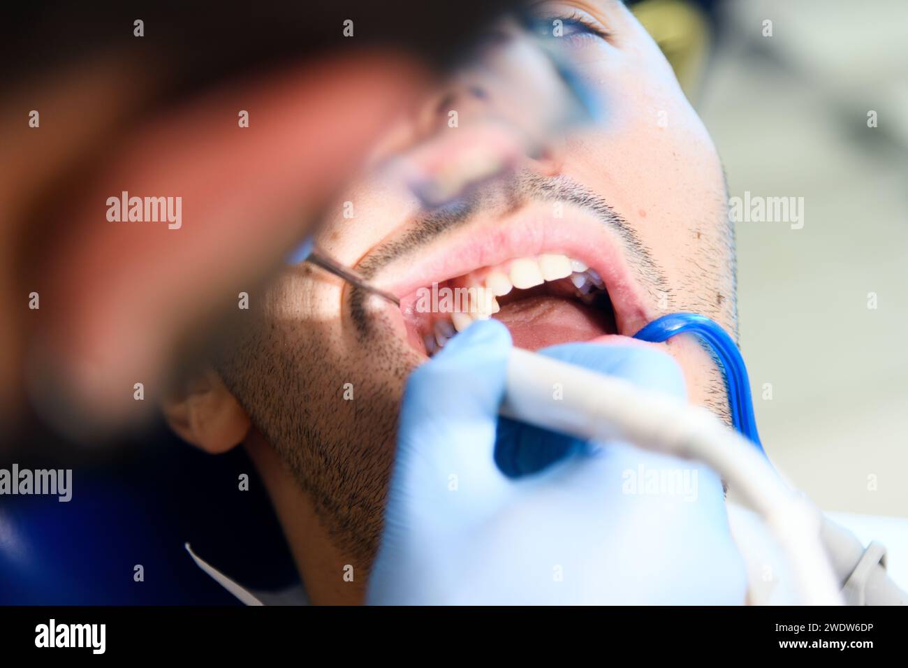 Expert dental whitening procedure in progress Stock Photo - Alamy