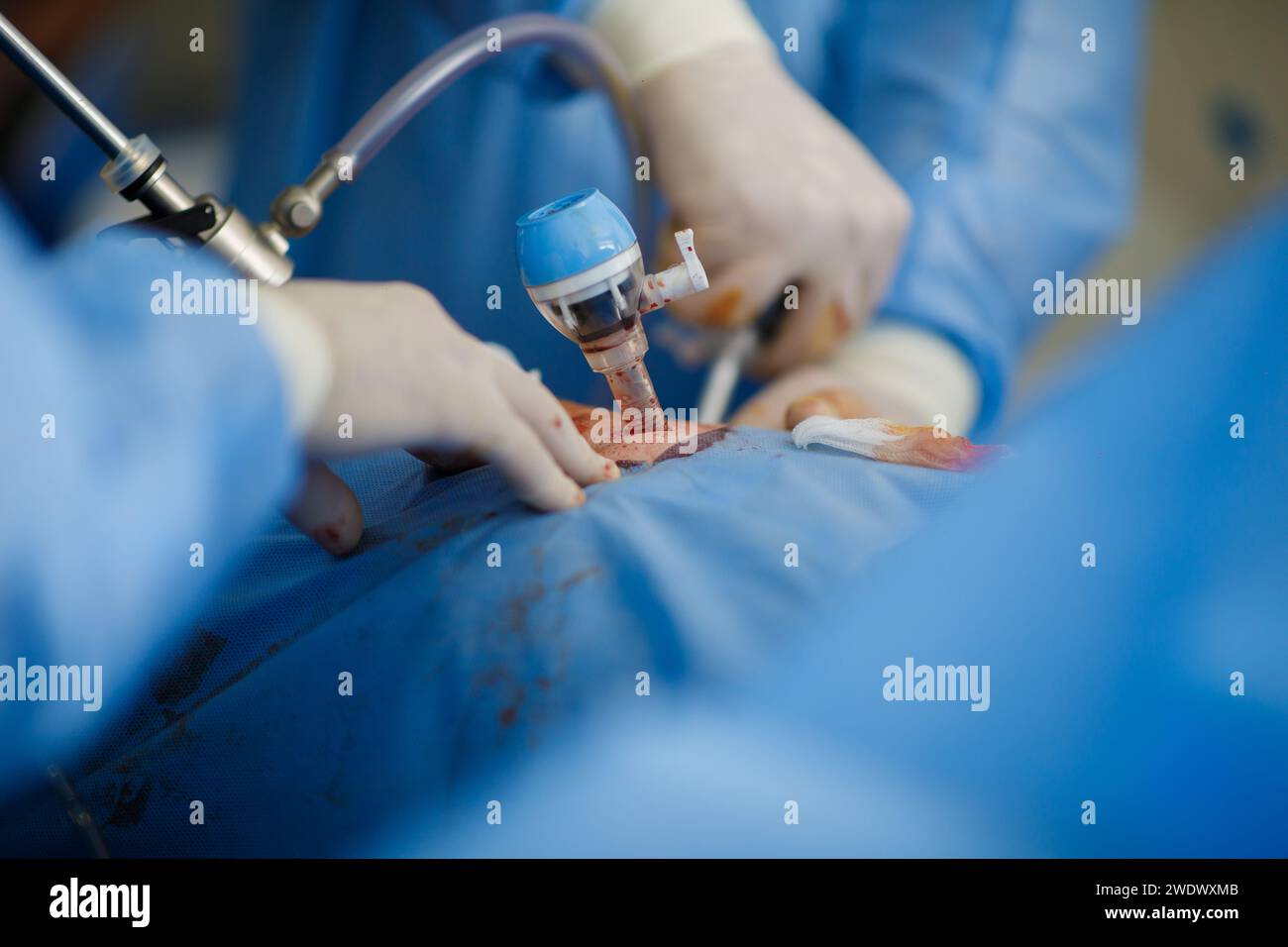 doctors perform laparoscopy operations in the intensive care unit. High ...