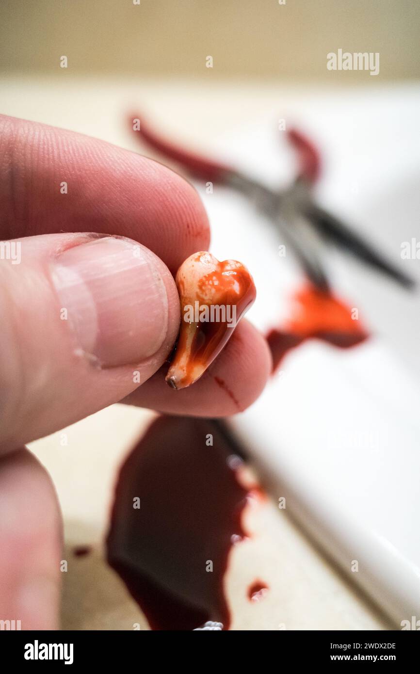Seattle, USA. 22 Jan, 2024. Self tooth extraction concept Stock Photo ...