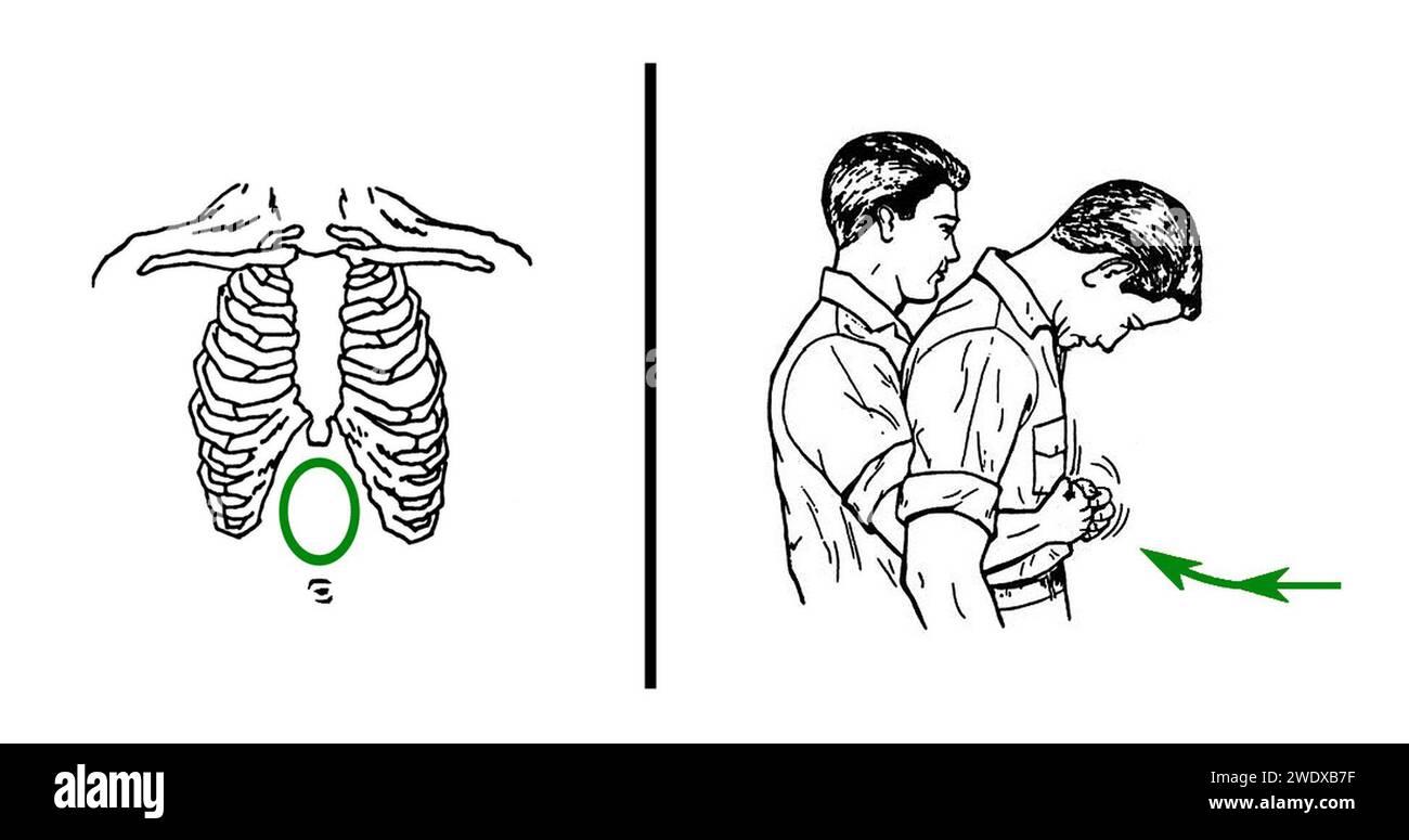 Abdominal thrusts against choking Stock Photo - Alamy