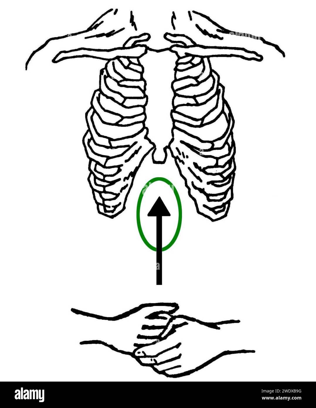Abdominal thrusts, point of applying Stock Photo - Alamy