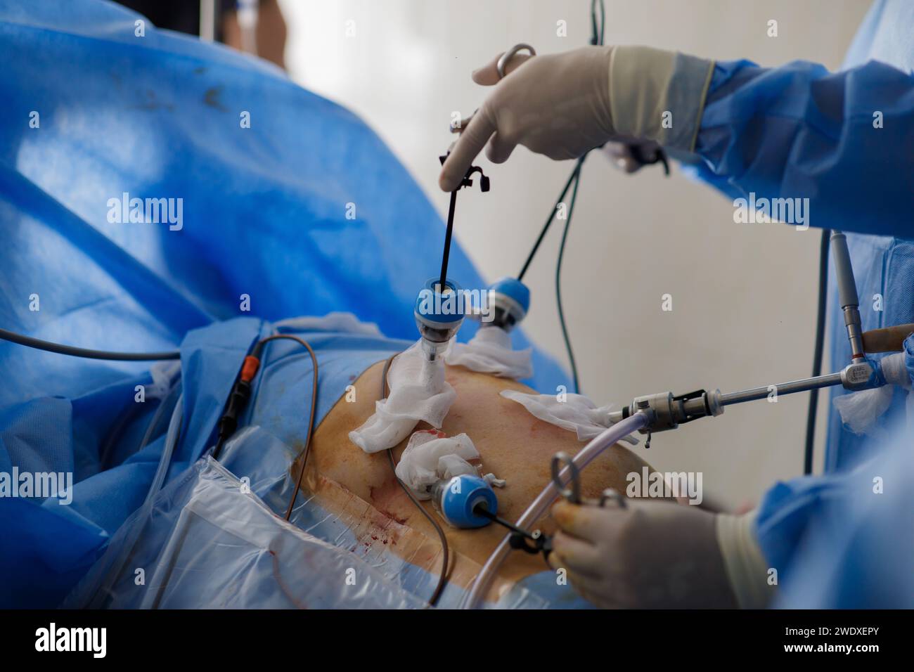 Abdominal laparoscopy in operating room hi-res stock photography and ...