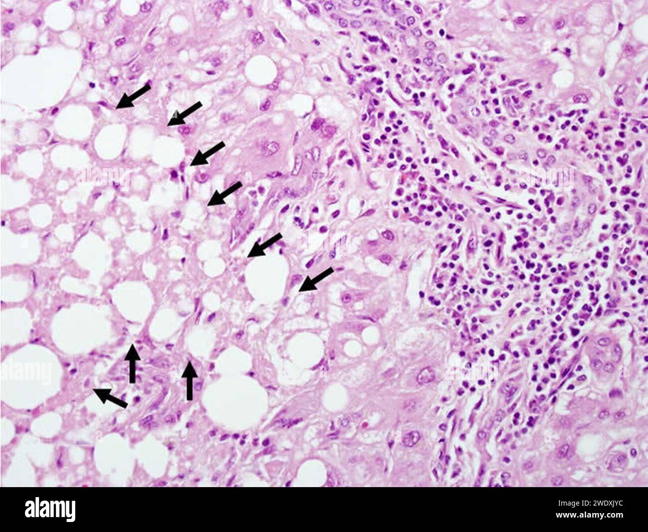 Acetominophen toxicity in the liver - portal area injury with necrotic ...