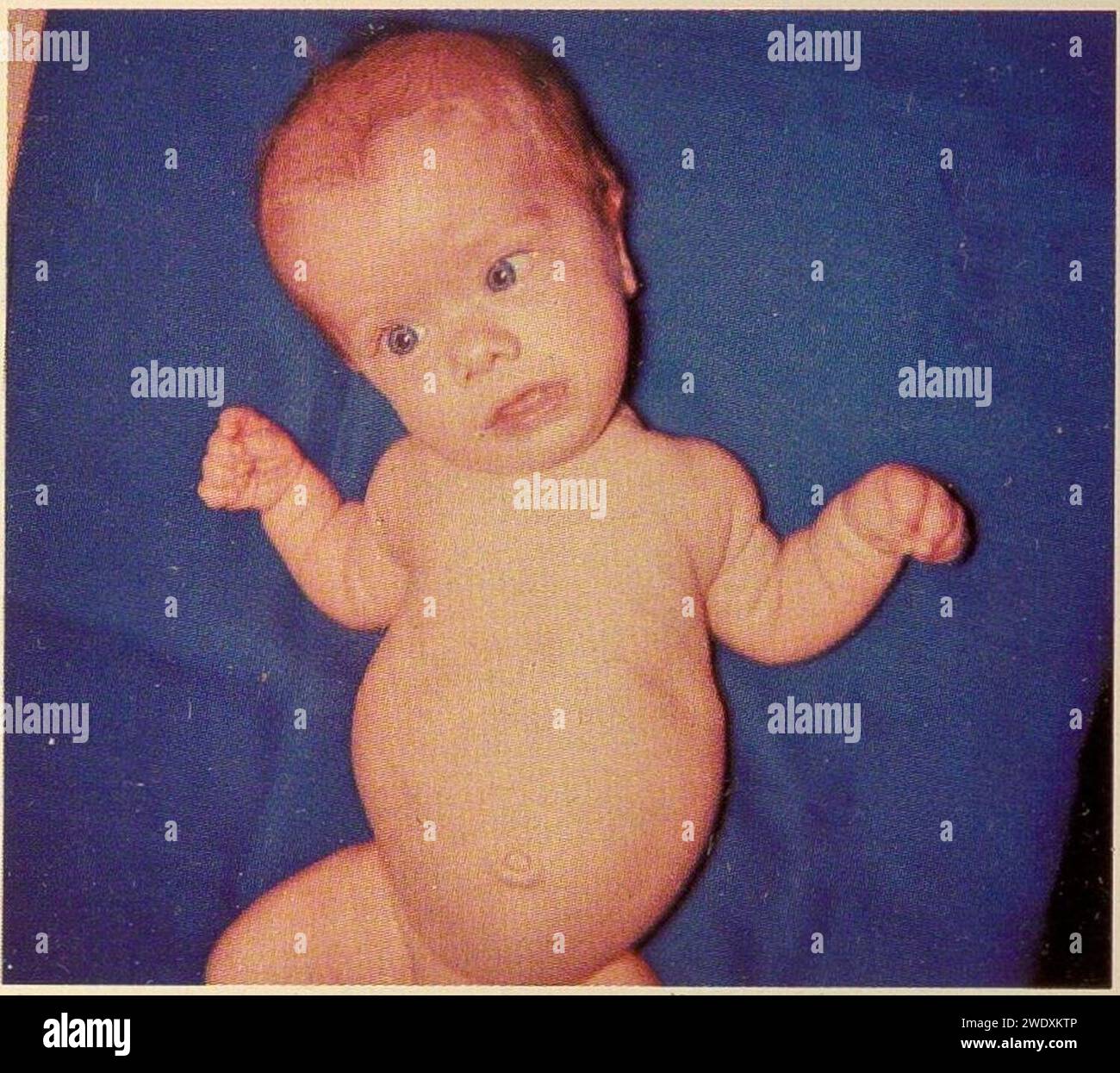 Achondroplasia Røntgen Av Hele Kroppen