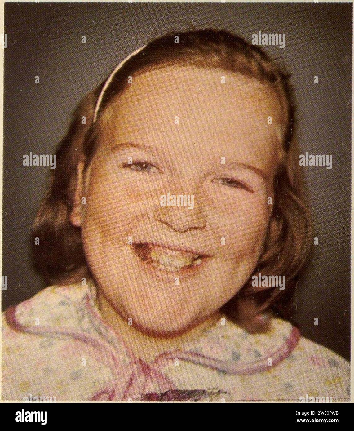 Albrights Hereditary Osteodystrophy 1 Stock Photo - Alamy