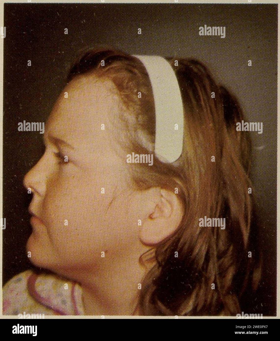 Albrights Hereditary Osteodystrophy 2 Stock Photo - Alamy