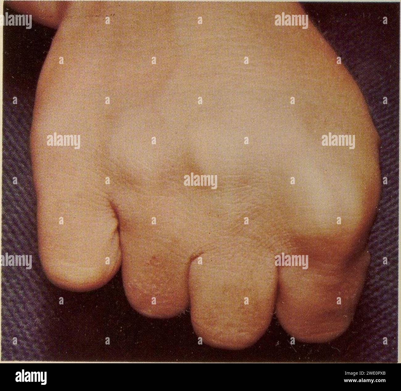 Albrights Hereditary Osteodystrophy 3 Stock Photo - Alamy