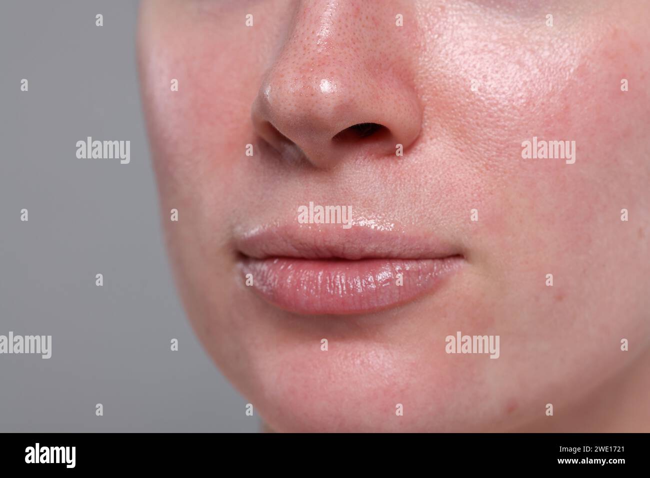 Closeup view of woman with reddened skin on grey background Stock Photo ...