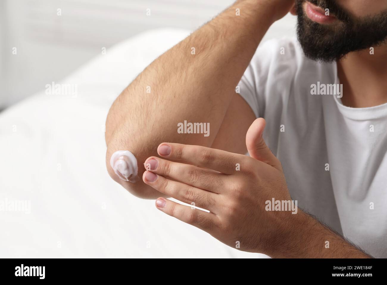 Man with dry skin applying cream onto his elbow on light background ...