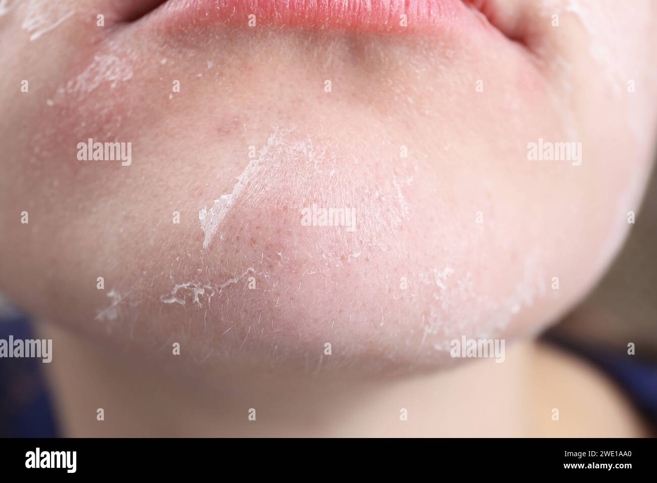 Woman with dry skin on face, closeup Stock Photo - Alamy