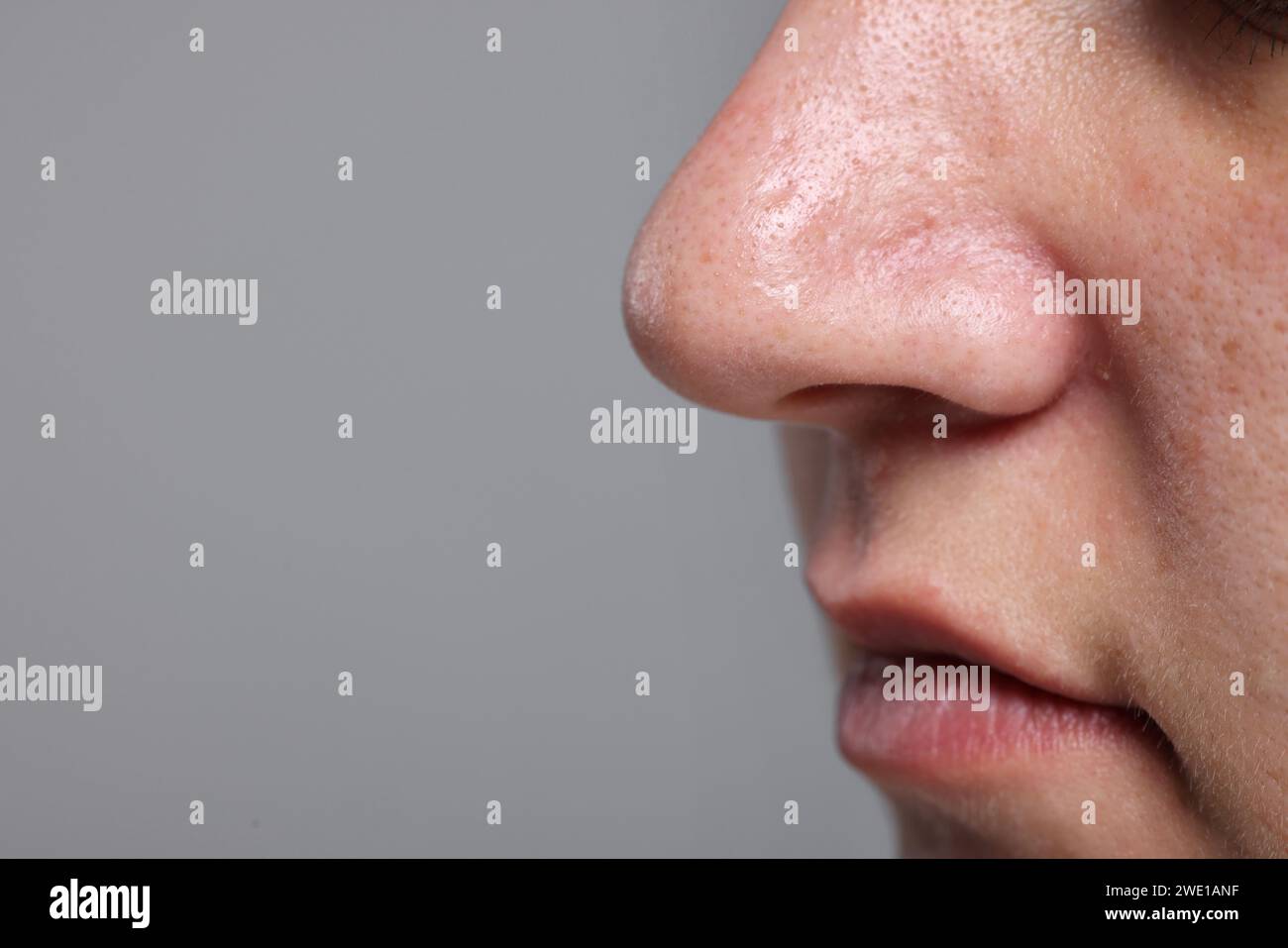 Unhealthy skin hi-res stock photography and images - Alamy