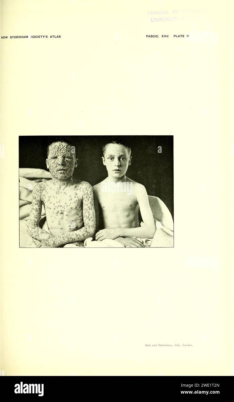 Allan Warner, photograph of two boys with smallpox (Atlas of Clinical ...