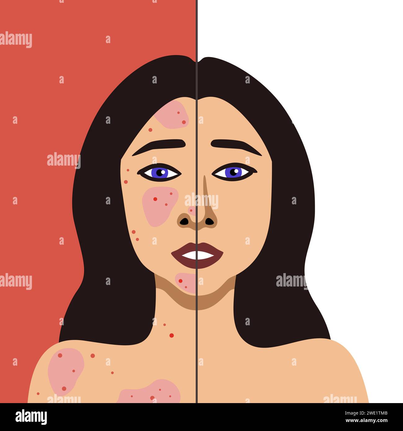Vector Image Of European Woman Before And After Acne Skin Treatment