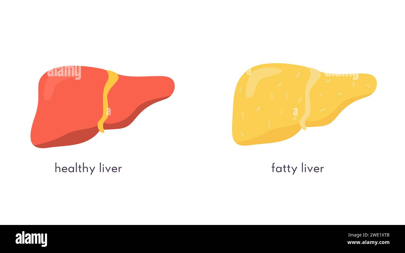Stages of nonalcoholic liver damage. Healthy and unhealthy fatty human ...