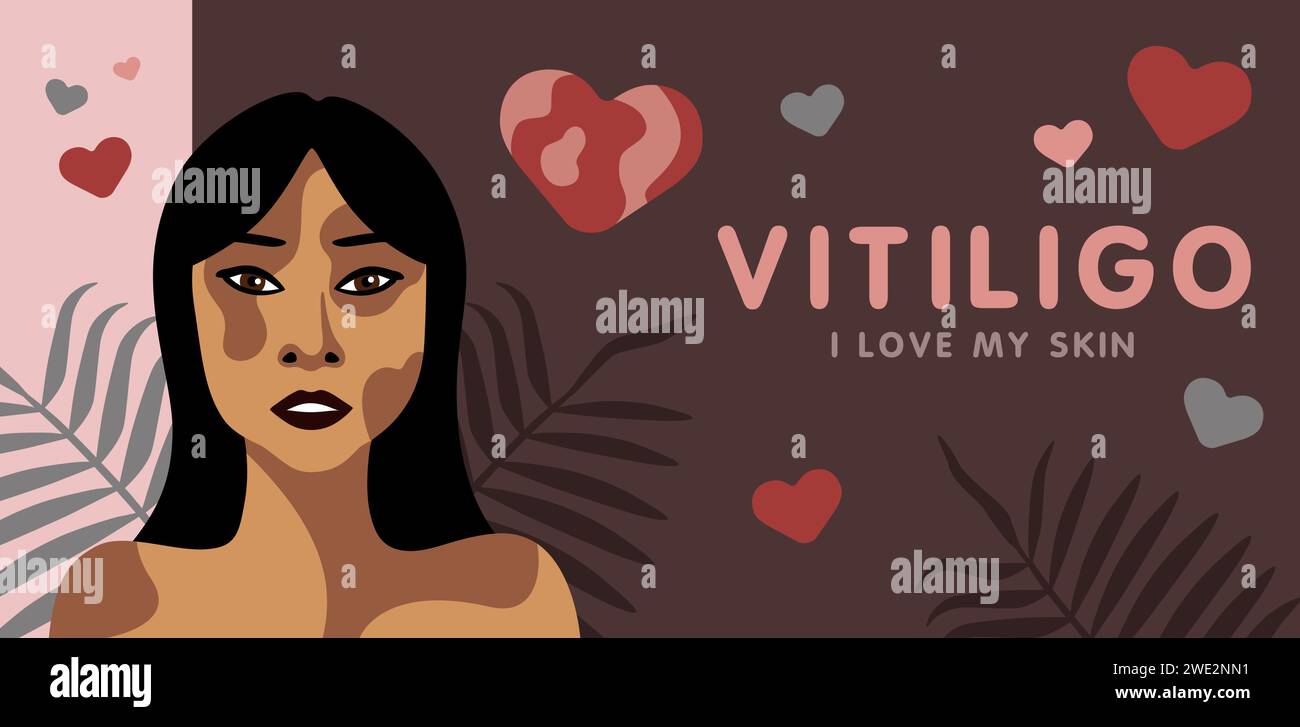 Banner about vitilingo skin disease with young beautiful woman of Asian appearance, minimalistic ...