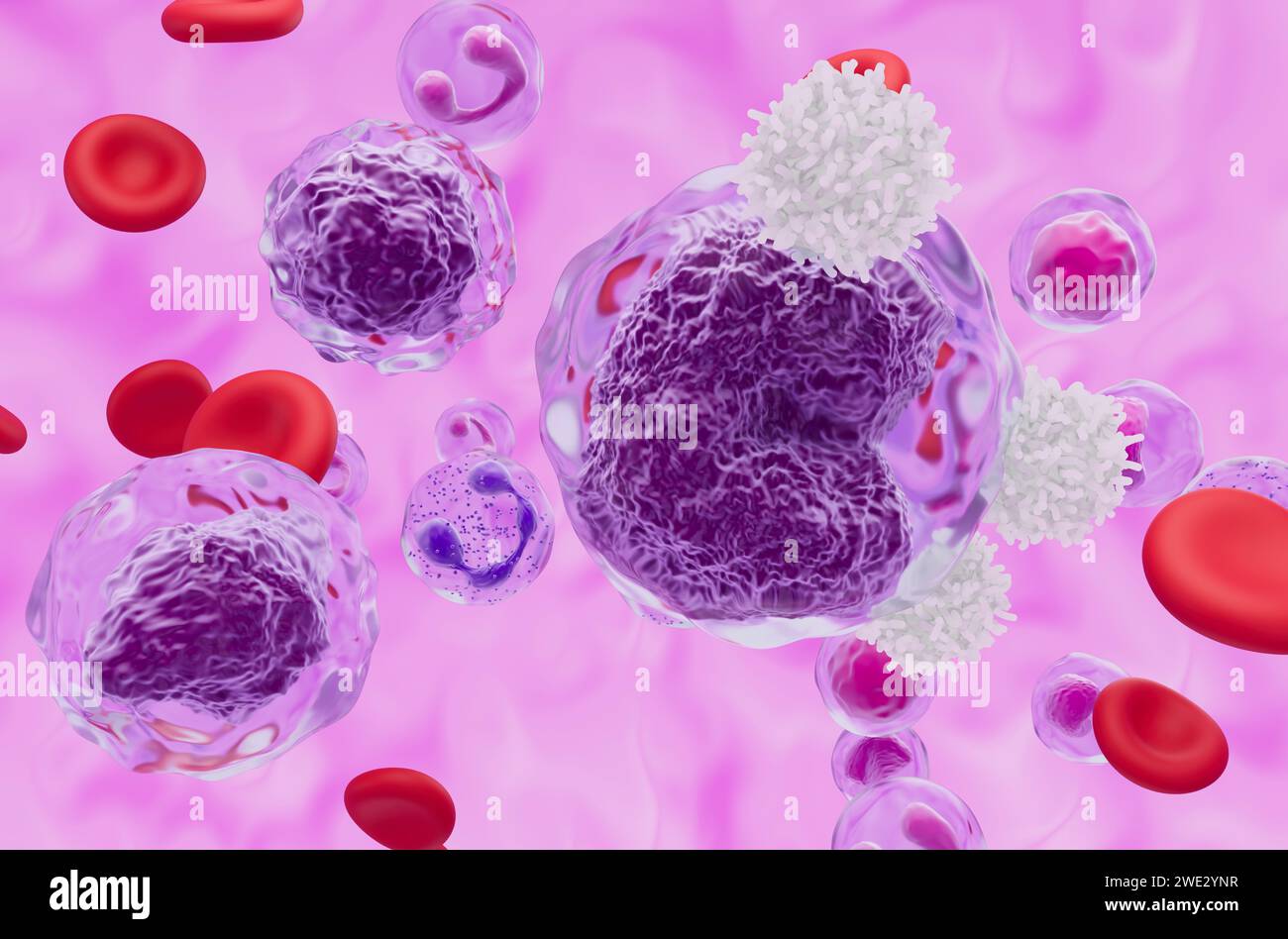 White blood cells with Non-hodgkin lymphoma (NHL) cells - closeup view ...